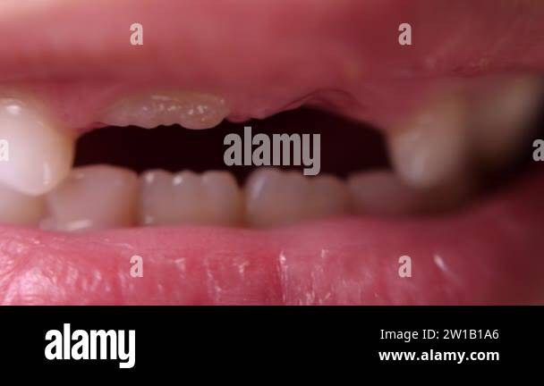 Baby teeth macro shoot. Toothless smile. A wobbly tooth. Cutting root ...