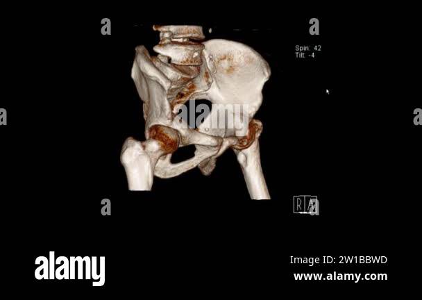 Computed Tomography Volume Rendering examination of the pelvis showing ...
