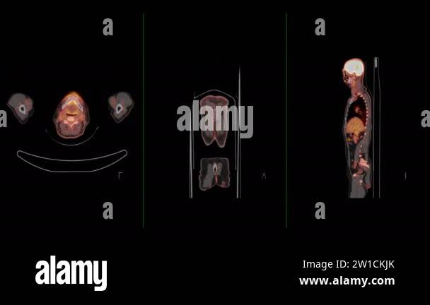 PET CT Scan of whole body compare axial , coronal and sagittal plane for detect tumor recurrence ...