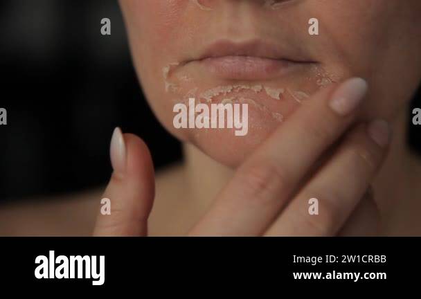 Woman's face after chemical peeling. Peeling skin on the face ...