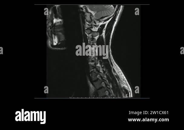 Magnetic Resonance images of Cervical spine sagittal T2-weighted images ...