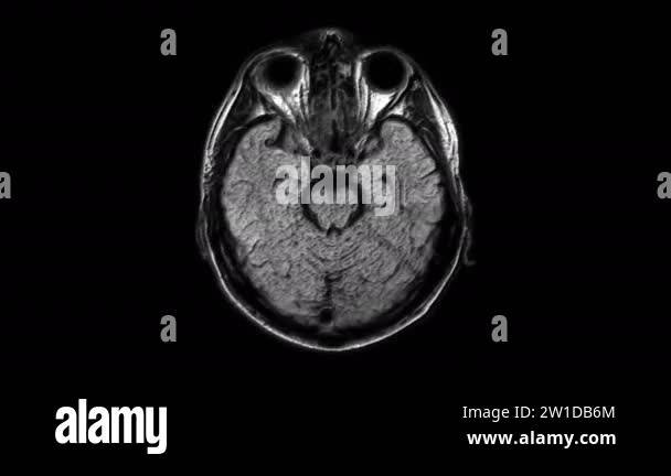 Voluminous MRI scans of the brain and head to detect tumors. Diagnostic ...