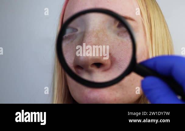 Expanded rosacea, pores, black spots, acne, close-up on the nose. A ...