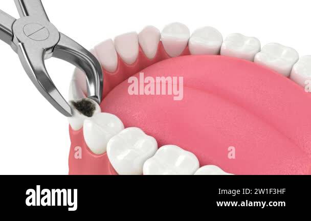 Crown extraction Stock Videos & Footage - HD and 4K Video Clips - Alamy