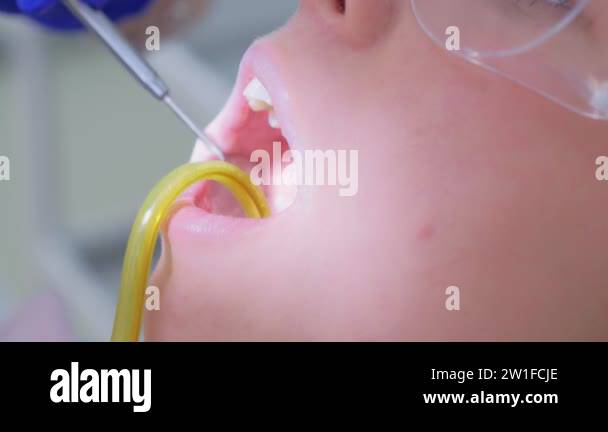 Dentist cleaning brushing and polishing womans teeth uses drill ...