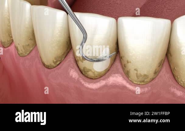 Oral hygiene: Scaling and root planing (conventional periodontal ...
