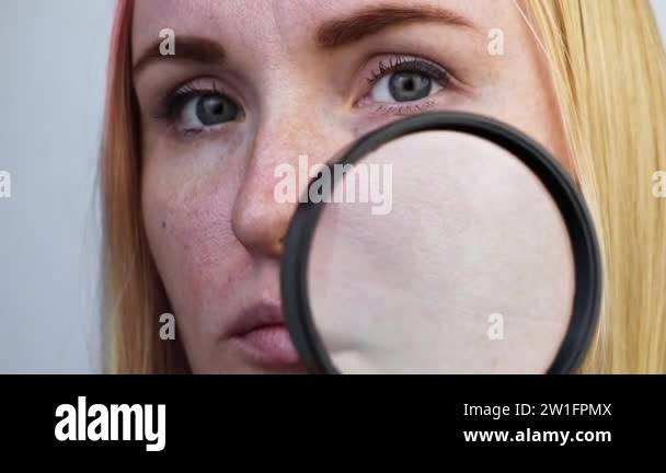 Expanded rosacea, pores, black spots, acne, close-up on the nose. A ...