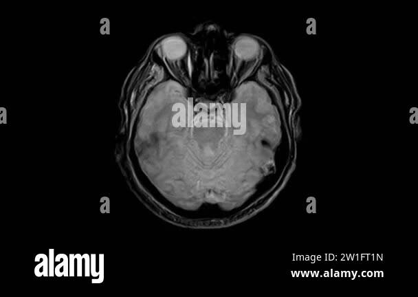 Brain MRI, head scans and tumor detection. Diagnostic medical tool ...