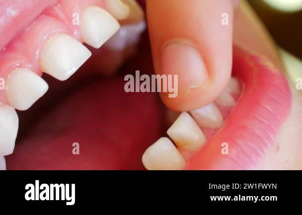 The child shows his first staggering tooth. Finger loosens babys tooth ...