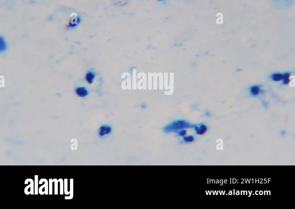 mycobacterium tuberculosis bacteria in human sputum under microscope ...