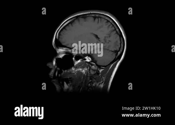 Time lapse of MRI brain scan, timelapse of monochrome magnetic ...