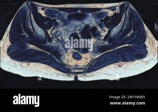 Bulk multicolored MRI of the female pelvic organs, abdominal cavity ...