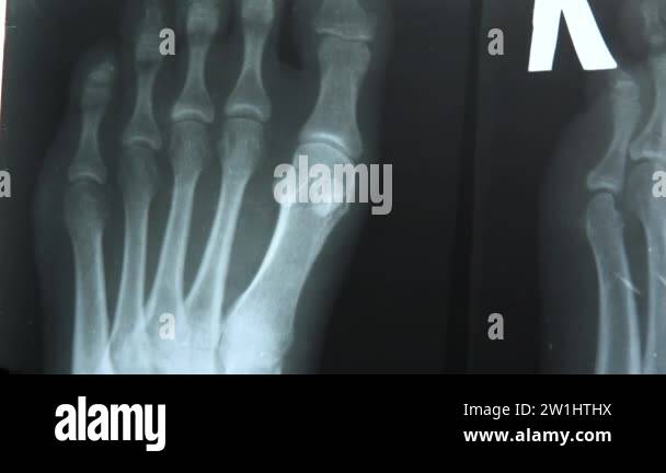X-ray of the feet close-up. X-ray image from top to bottom Stock Video ...