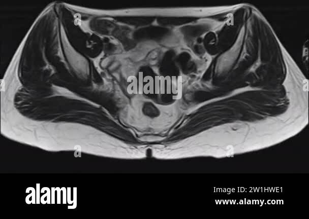 MRI of the female pelvic organs, abdominal cavity, gastrointestinal ...
