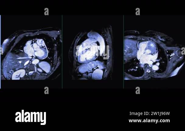 MRI heart or Cardiac MRI magnetic resonance imaging of heart in 3 ...