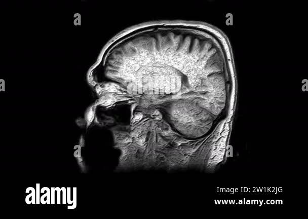 Voluminous MRI scans of the brain and head to detect tumors. Diagnostic ...