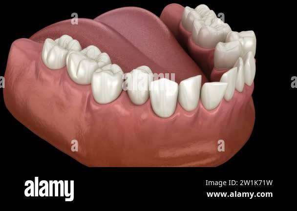 Overcrowding dental occlusion ( Malocclusion of teeth Stock Video ...