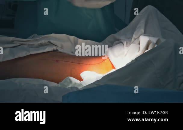 Surgical incision bleeding Stock Videos & Footage - HD and 4K Video ...