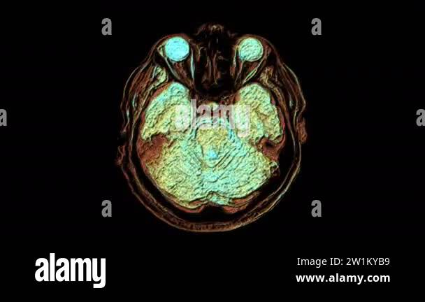 Bulk multicolored MRI scans of the brain and head to detect tumors ...