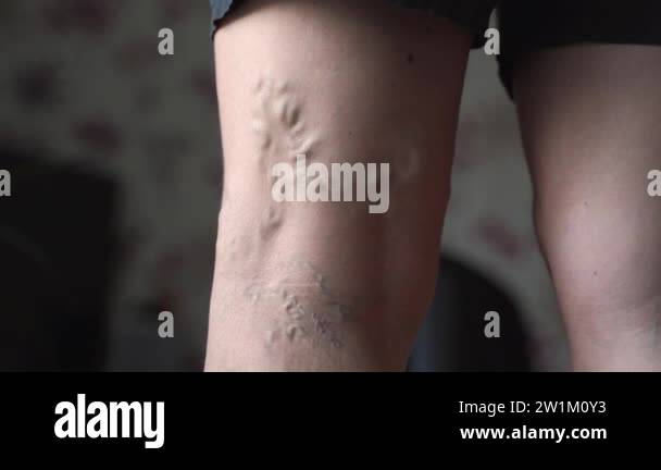 Varicose veins on woman legs indoors. Vascular health problem. Trombose ...