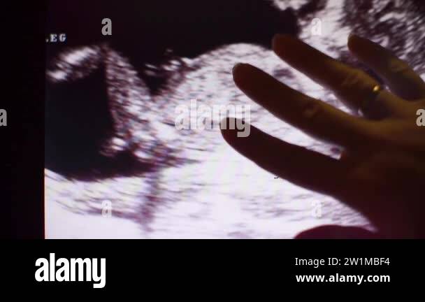 Black and white photo of an ultrasound scan of an embryo of a human ...