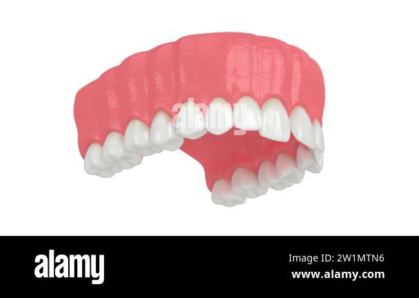 Upper jaw with abnormal teeth position. Orthodontic treatment concept ...