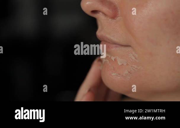 Peeling skin on the face. Womans face after chemical peeling ...