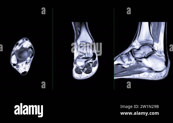 Compare of mri ankle joint axial, coronal and sagittal T2 for diagnosis ...