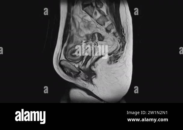 MRI of the female pelvic organs, abdominal cavity, gastrointestinal ...