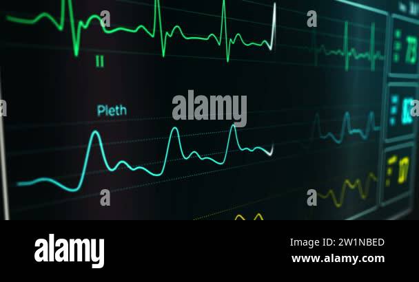 ECG heart beat rate cardio monitor in hospital. EKG electrocardiogram ...