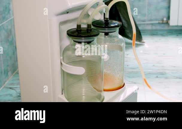 close-up. fat pumped out from patient during abdominal liposuction ...