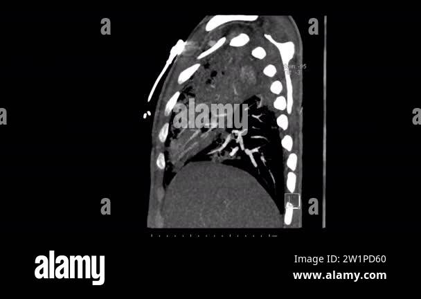 Pulmonary tuberculosis Stock Videos & Footage - HD and 4K Video Clips ...