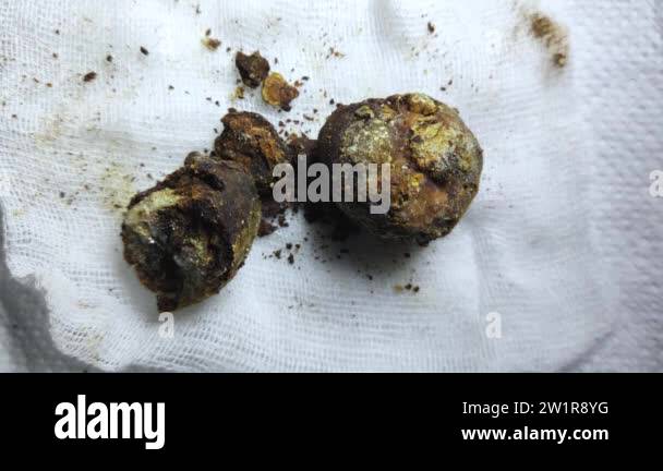 Gallstones close up. Calculi in the hands of the surgeon after ...