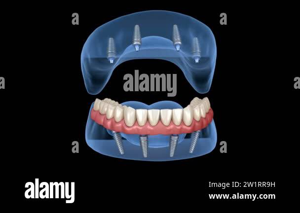 Maxillary and Mandibular prosthesis with gum All on 4 system supported ...