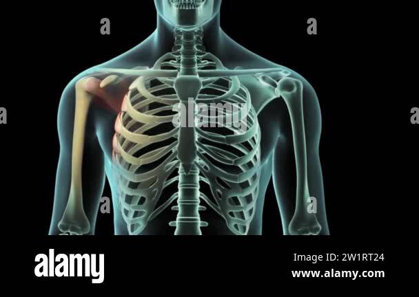 A rotator cuff tear is an injury of one or more of the tendons or ...