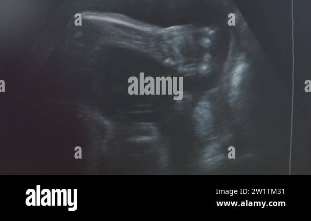 Ultrasonography of pregnant woman. Unborn baby in womb moving during ...