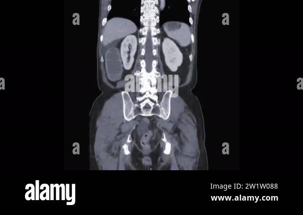 Ct scan of the abdomen showing abscess Stock Videos & Footage - HD and ...