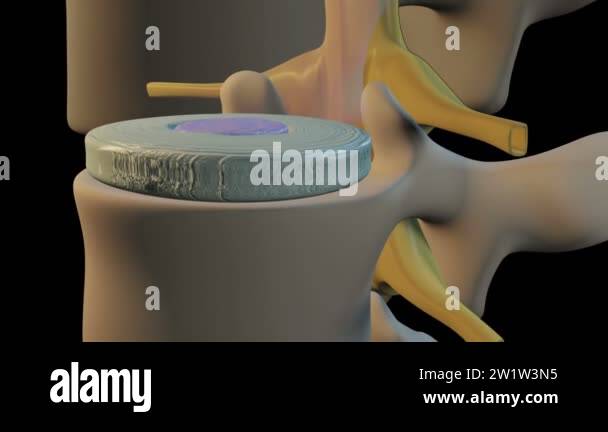 Bulging disc spine Stock Videos & Footage - HD and 4K Video Clips - Alamy