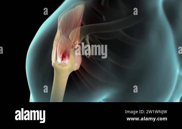 A rotator cuff tear is an injury of one or more of the tendons or ...