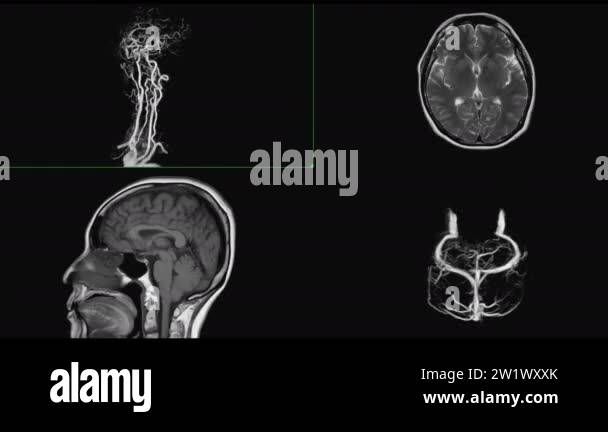 X-ray C-spine or x-ray image of Cervical spine AP view with cta carotid ...