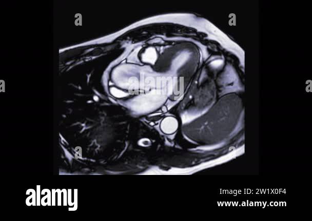 Cardiac mri Stock Videos & Footage - HD and 4K Video Clips - Alamy