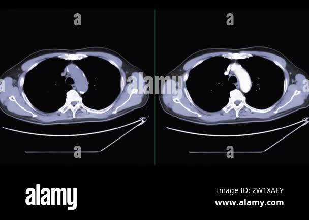 Chest X-ray with 3D rendering image CTA whole aorta inside chest Stock ...
