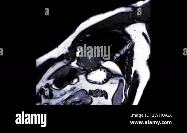 MRI heart or Cardiac MRI magnetic resonance imaging of heart in short ...