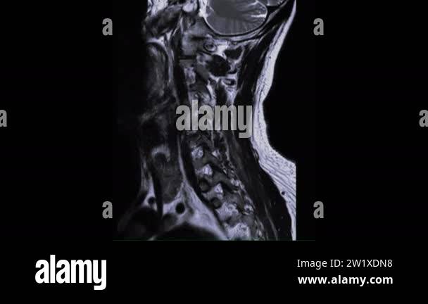 MRI of cervical spine sagittal T2W view for diagnostic Spinal Cord ...