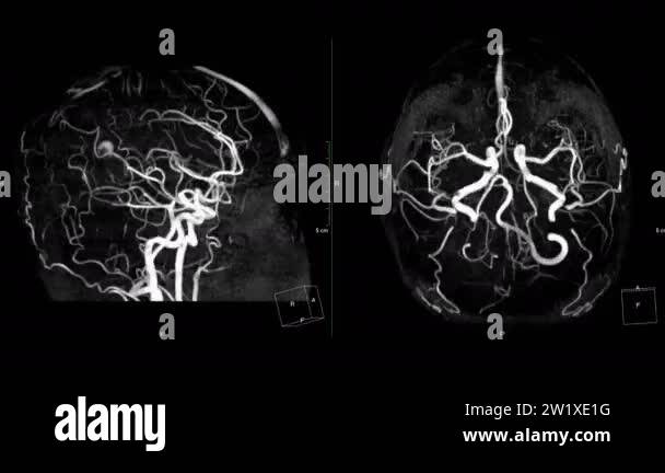 Brain artery mri Stock Videos & Footage - HD and 4K Video Clips - Alamy