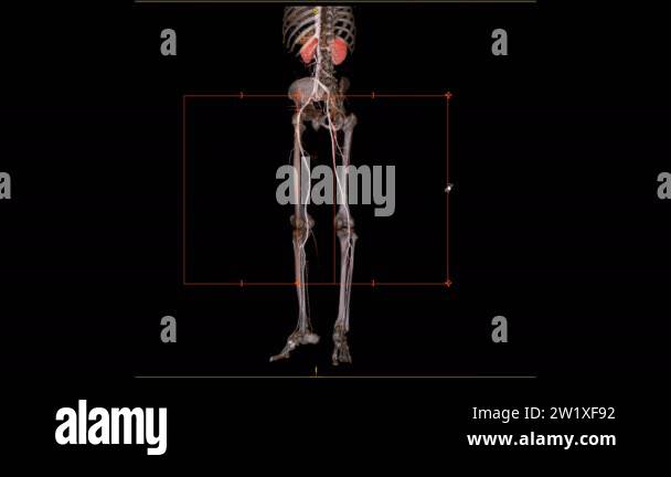 footage of CTA femoral artery 3d render isolated on black Stock Video ...