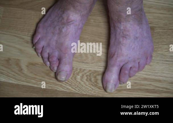 Close-up of old sick female feet with crooked toes and long scary nails ...