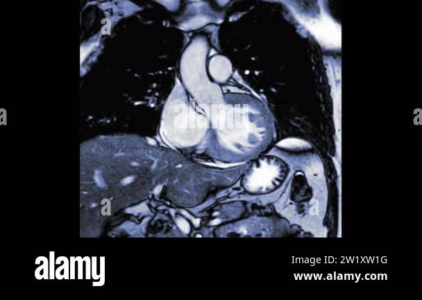 MRI heart or Cardiac MRI magnetic resonance imaging of heart in LVOT ...