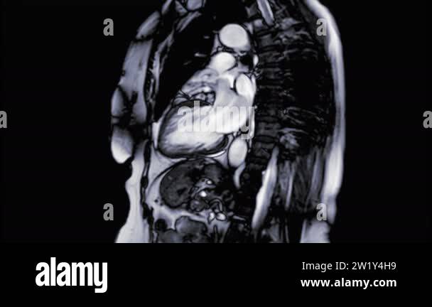 MRI heart or Cardiac MRI magnetic resonance imaging of heart in 3 ...
