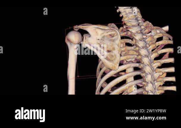 CT scan 3D rendering of Left shoulder showing fracture head of humerus ...
